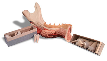 Advanced Lower Half Jaw with 8 Additional Diseased Teeth | College of ...